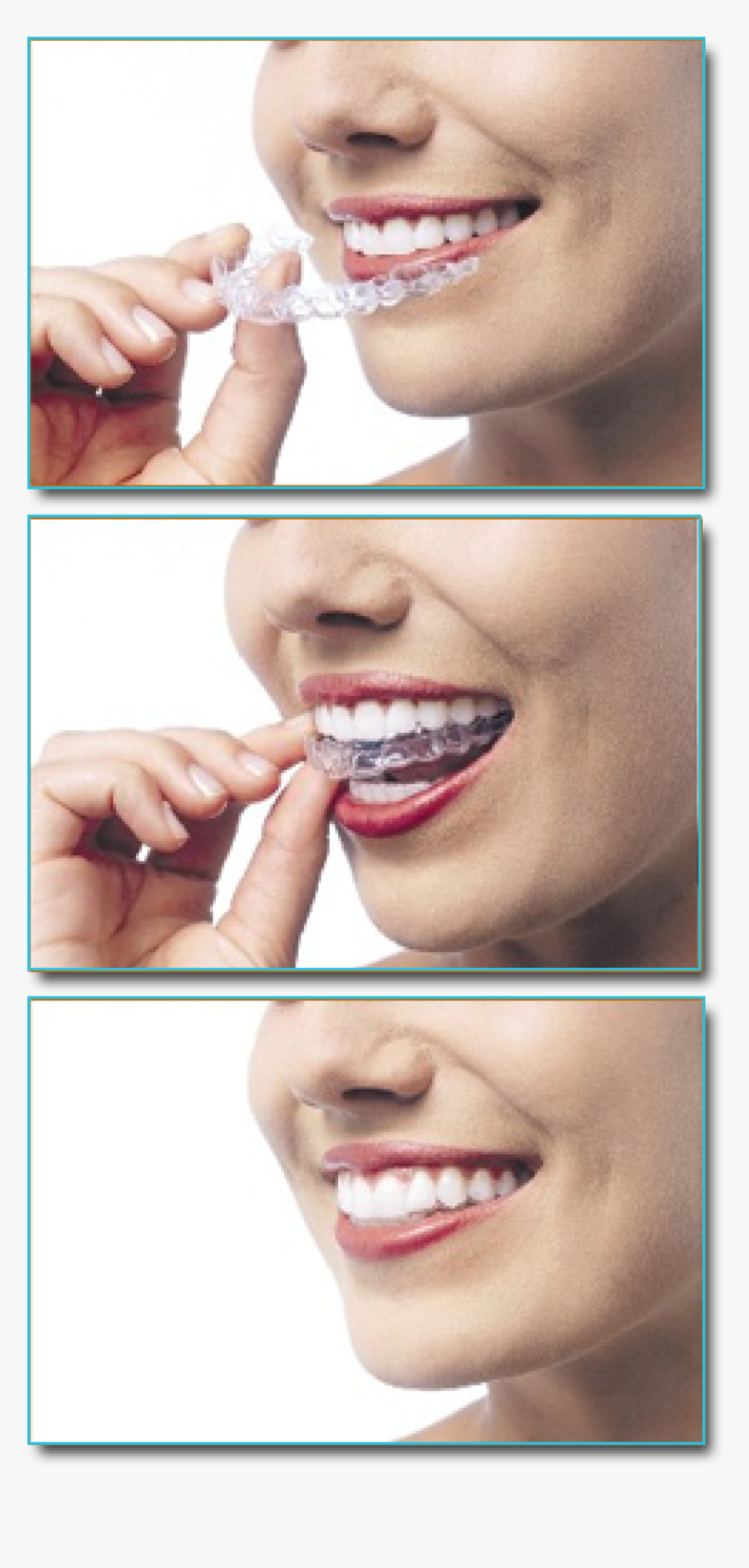 Invisalign - Someone With Clear Aligners, HD Png Download , Transparent ...