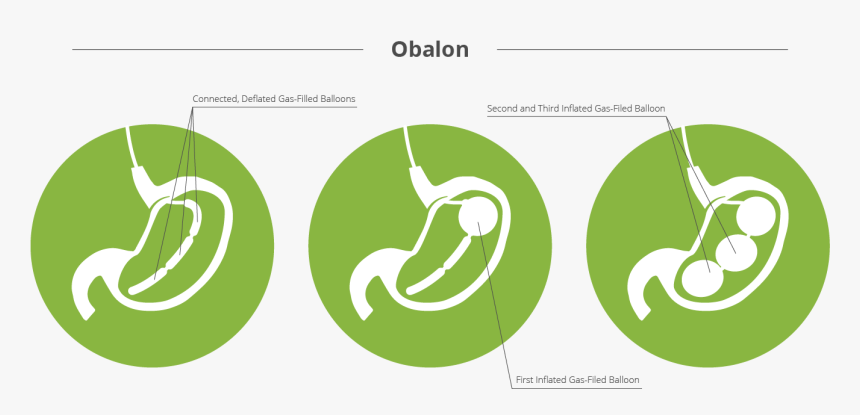Obalon - Graphic Design, HD Png Download , Transparent Png Image - PNGitem