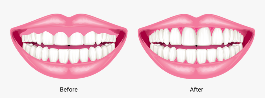 Gum Drawing Front Tooth - Gums, HD Png Download , Transparent Png Image ...