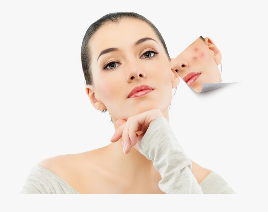 Acne Png, Transparent Png , Transparent Png Image - PNGitem