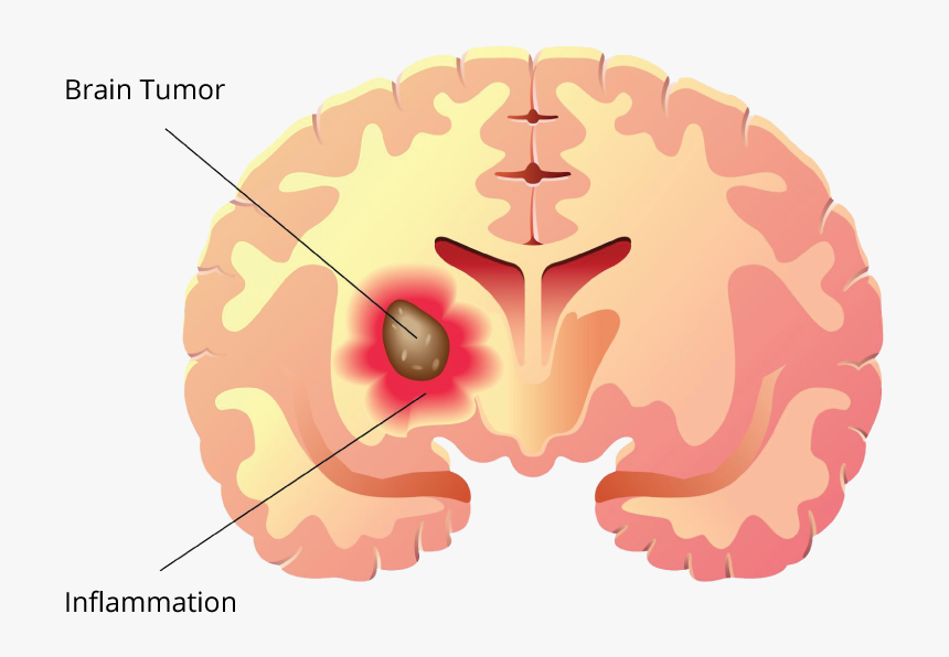 Brain Tumor Label - Brain Tumor Clipart, HD Png Download , Transparent ...