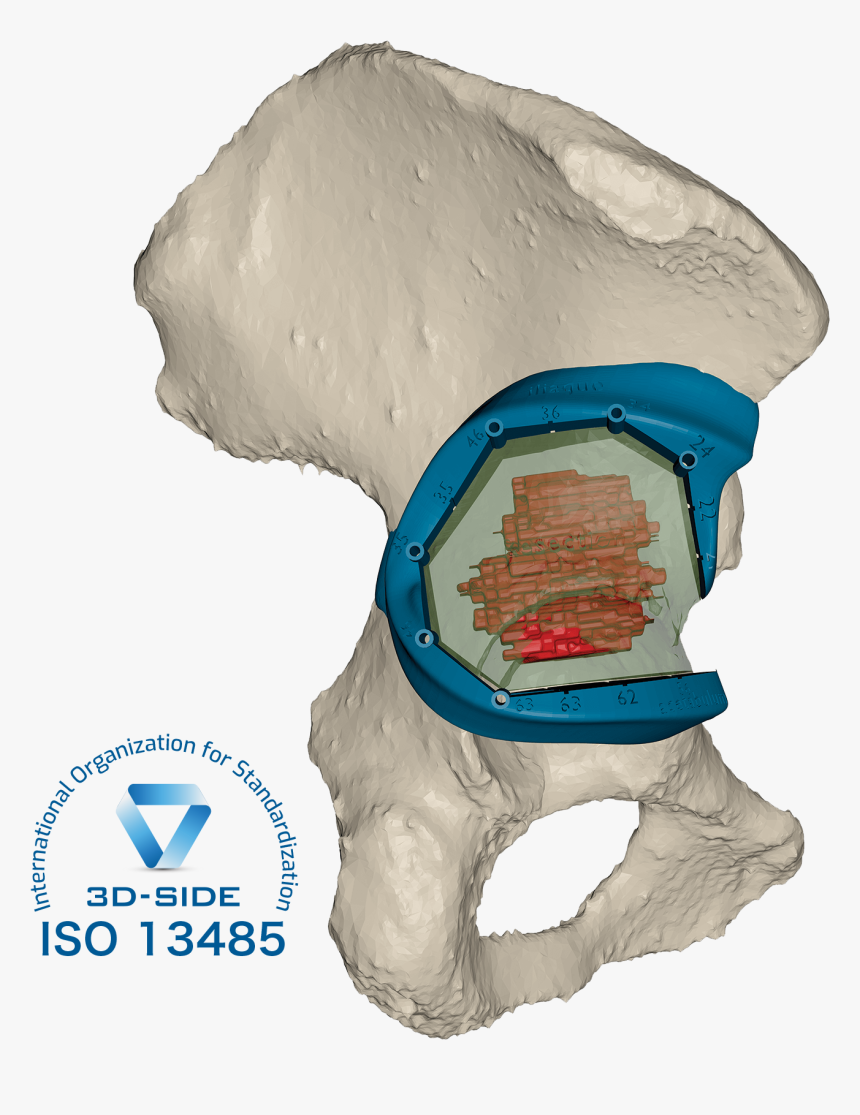 Bone Tumor Resection - Illustration, HD Png Download , Transparent Png ...