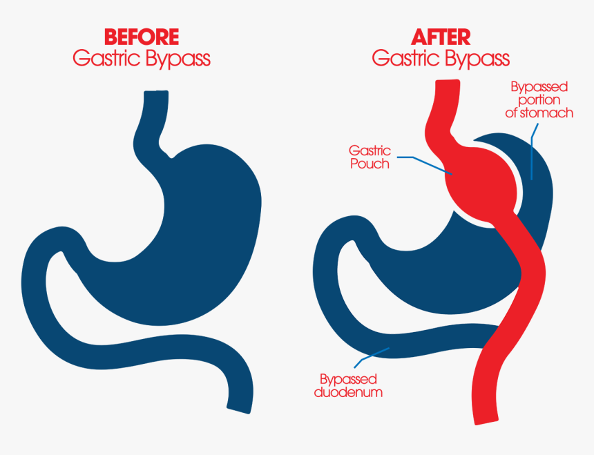 Mini Bypass, HD Png Download , Transparent Png Image - PNGitem